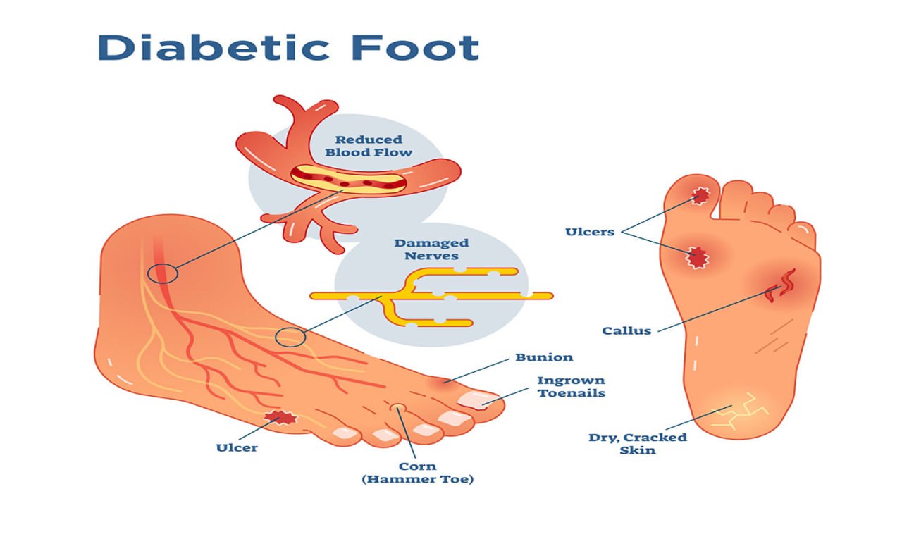 Diabetic Foot Awareness