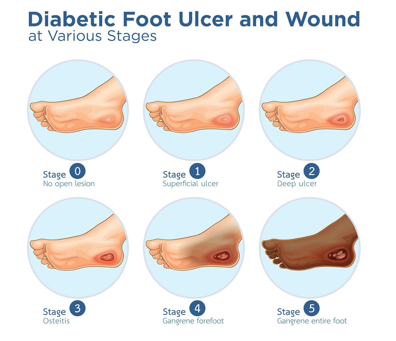 Diabetic Foot Awareness